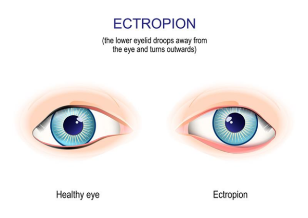 All About Ectropion: Causes, Symptoms, and Available Treatments - NEO ...